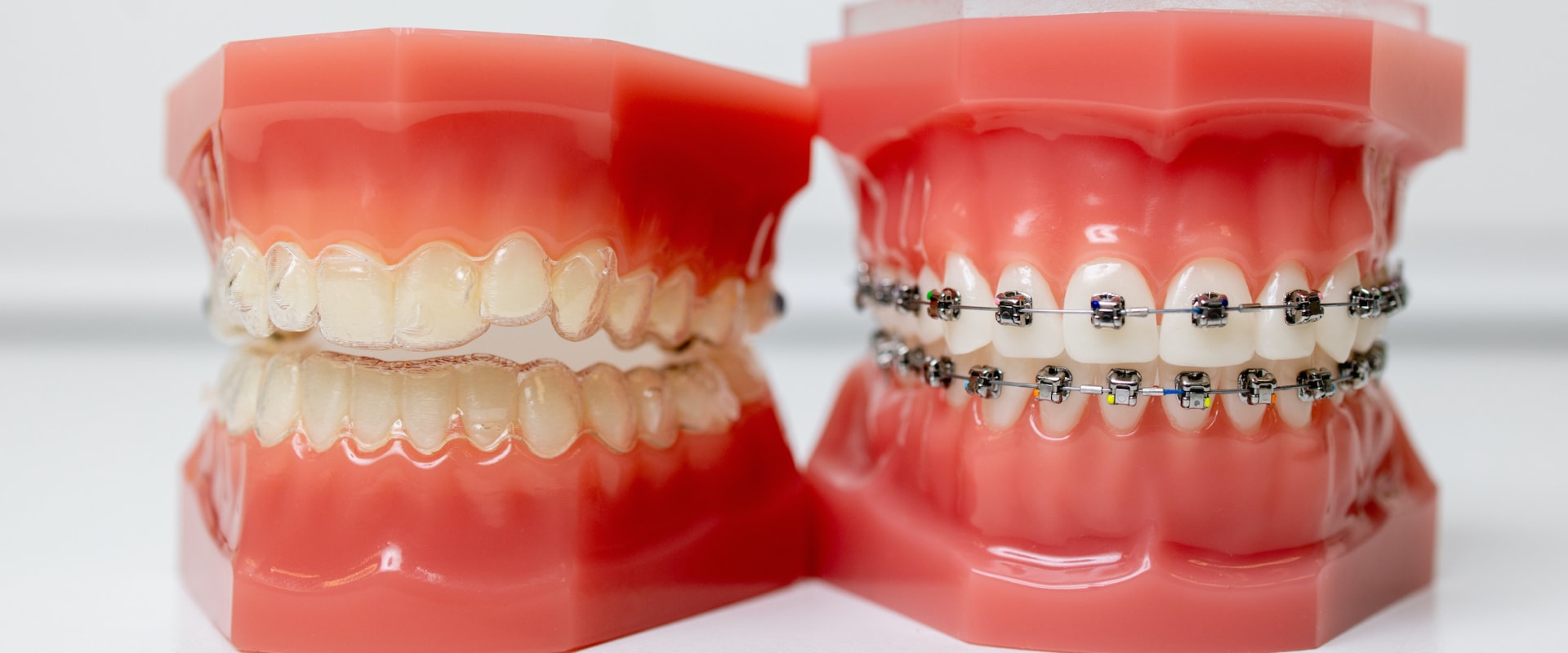 7 Life-Changing Benefits of Straightening Your Teeth